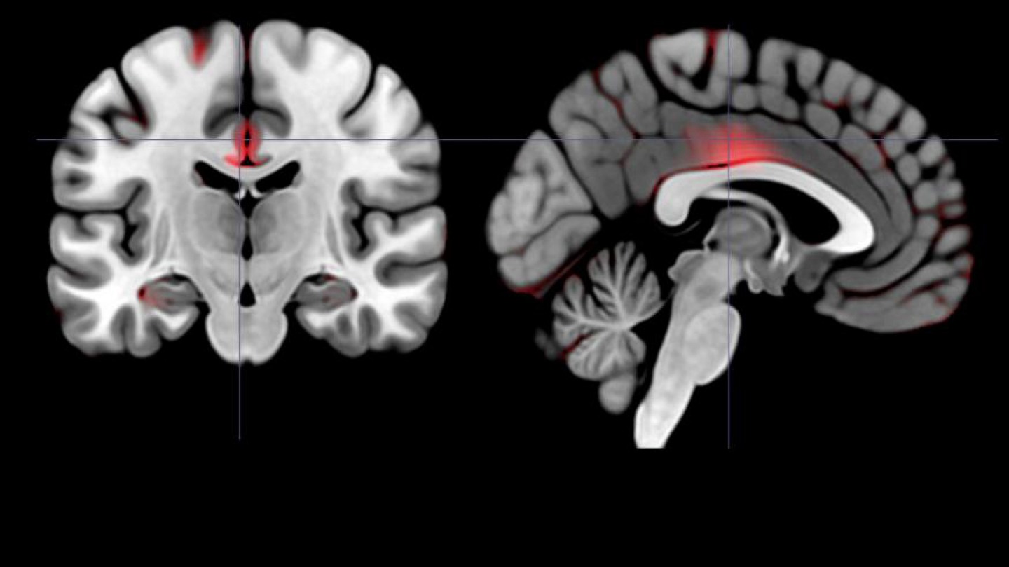 Study Maps Extroversion Types In The Brain’s Anatomy | School of Public ...